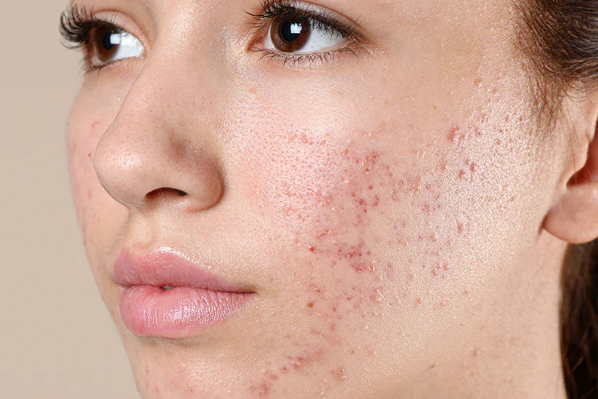 The Best Skincare Ampoules for Acne Prone Skin – STAYVEUSA